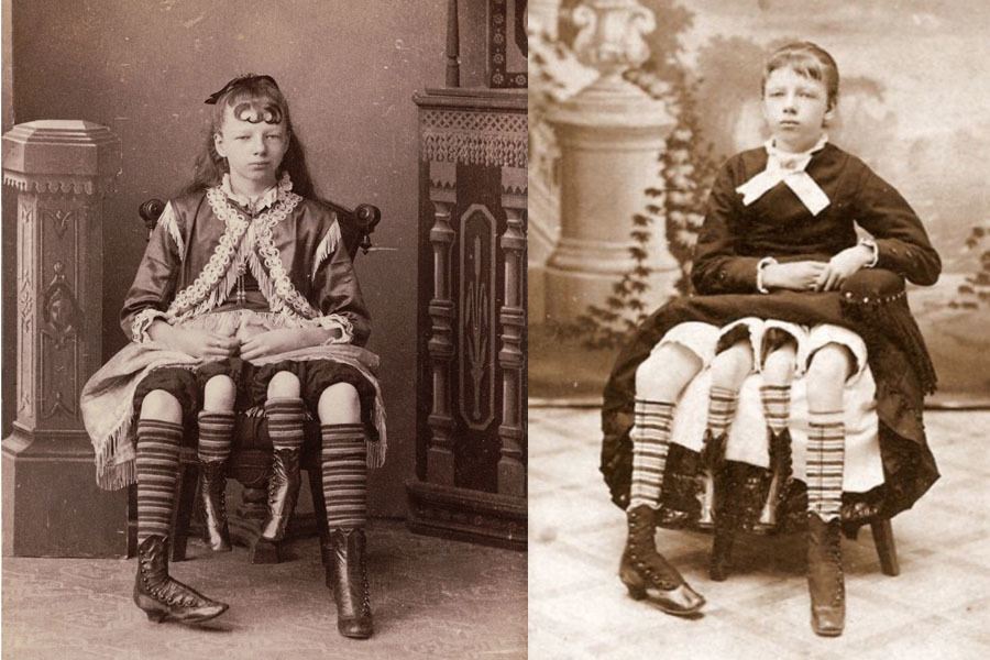 Myrtle Corbin, “The Four-Legged Girl from Texas” – The Devil's Muse